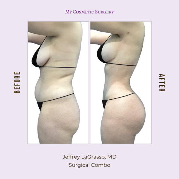 Jeffrey LaGrasso, MD | Surgical Combo - My Cosmetic Surgery