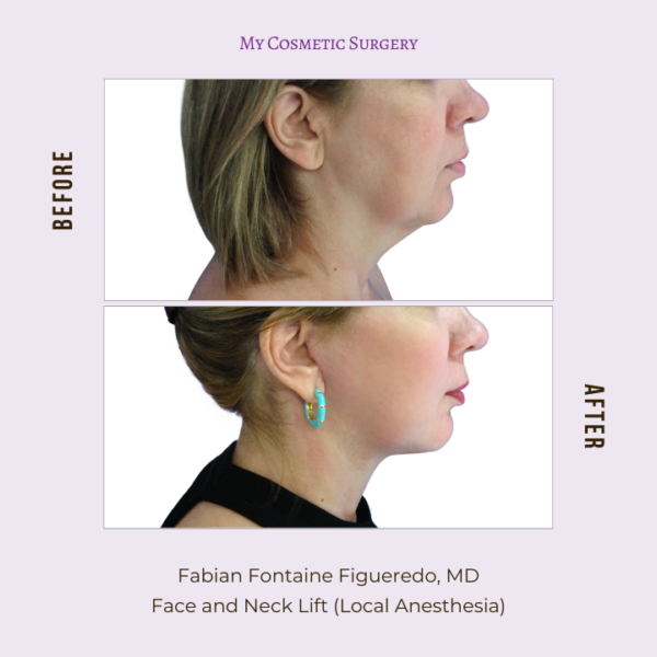 Fabian Fontaine Figueredo, MD | Face and Neck Lift - My Cosmetic Surgery