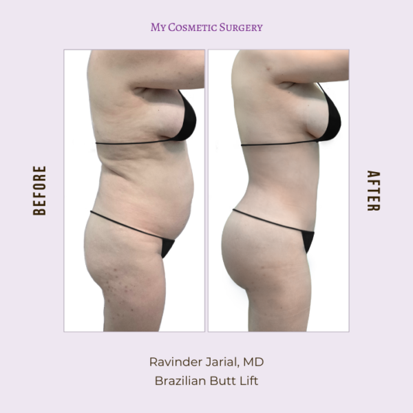 Ravinder Jarial, DO | Brazilian Butt Lift - My Cosmetic Surgery
