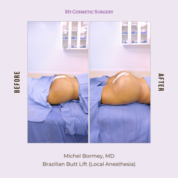 Michel Bormey, MD | Brazilian Butt Lift - My Cosmetic Surgery