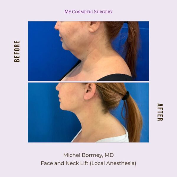 Michel Bormey, MD | Face and Neck Lift - My Cosmetic Surgery